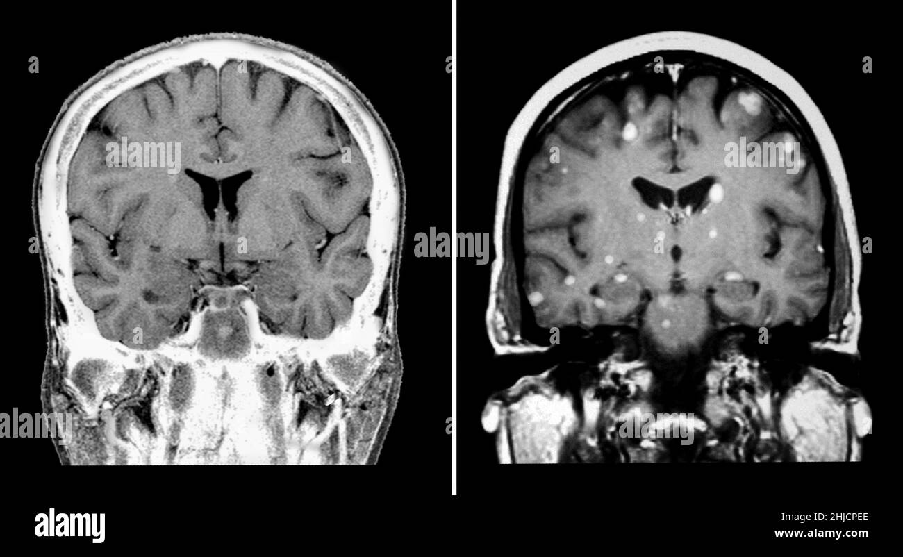 On the left is a normal coronal (frontal view) cross-sectional MRI ...