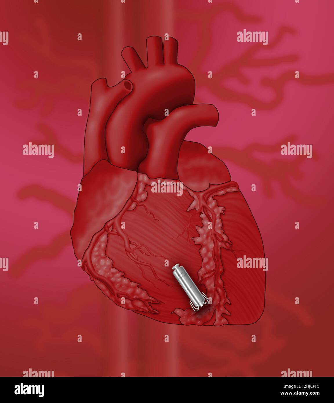 Conceptual image of a leadless pacemaker. It is much smaller than a ...