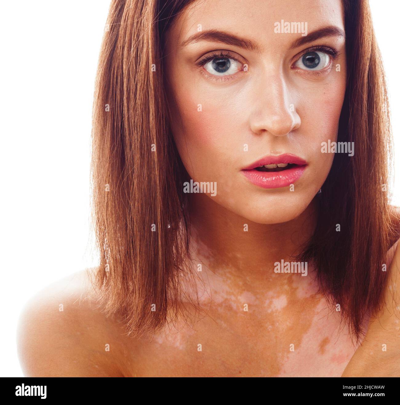 beautiful young brunette woman with vitiligo disease close up isolated ...