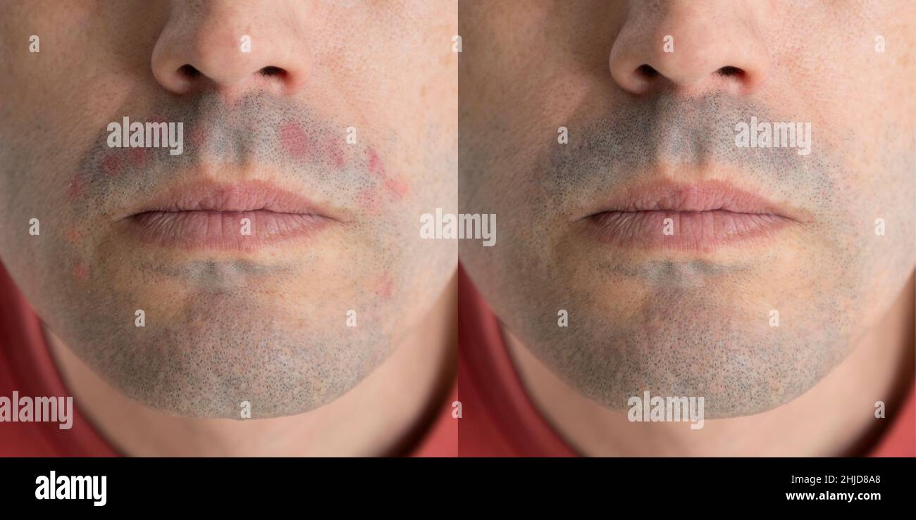 Photo with and without dermatitis. Concept of irritated skin in men ...