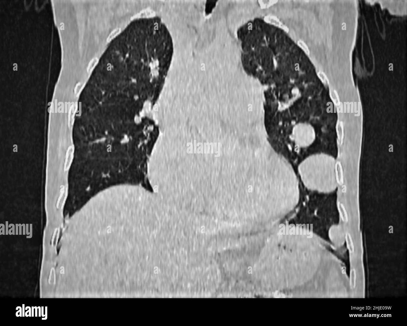 Metastatic disease to lungs hi-res stock photography and images - Alamy