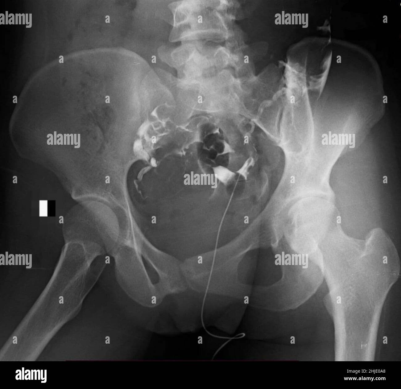 Healthy female reproductive system, X-ray Stock Photo - Alamy