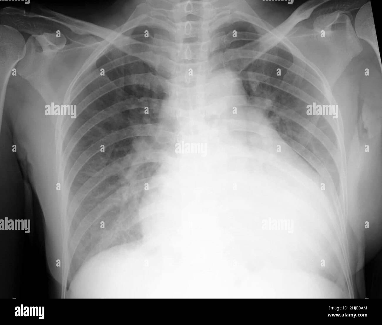 Enlarged heart and pulmonary oedema, X-ray Stock Photo - Alamy
