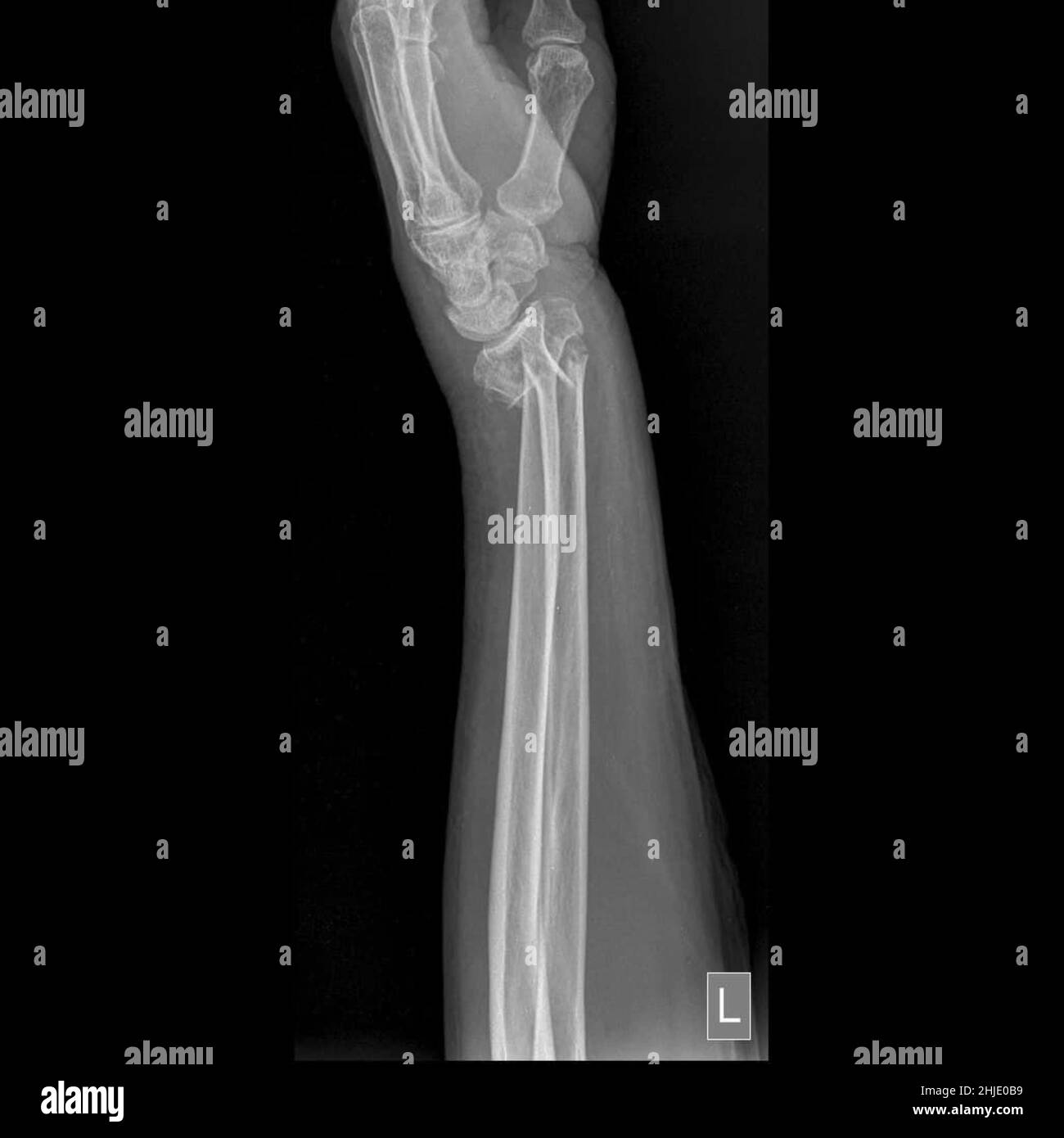 Distal radius fracture hi-res stock photography and images - Alamy