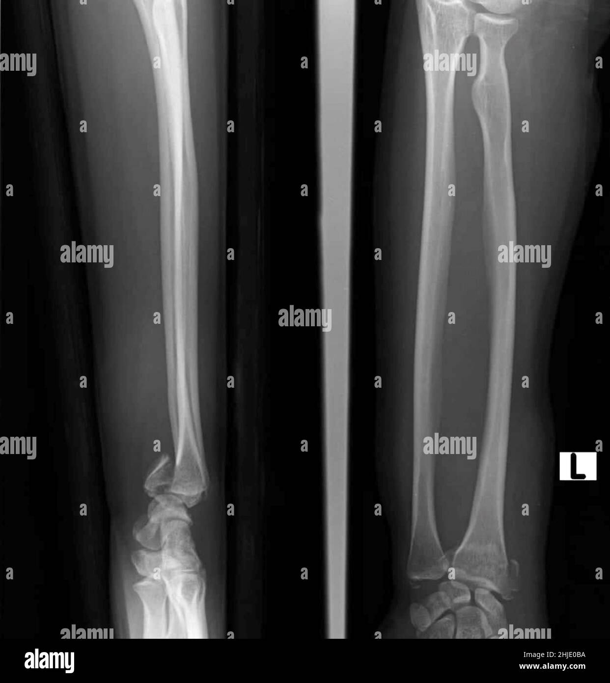 Smith fracture, X-ray Stock Photo - Alamy