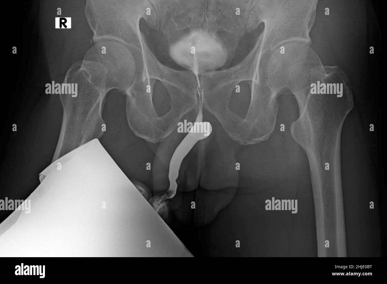 Urethra hi-res stock photography and images - Alamy