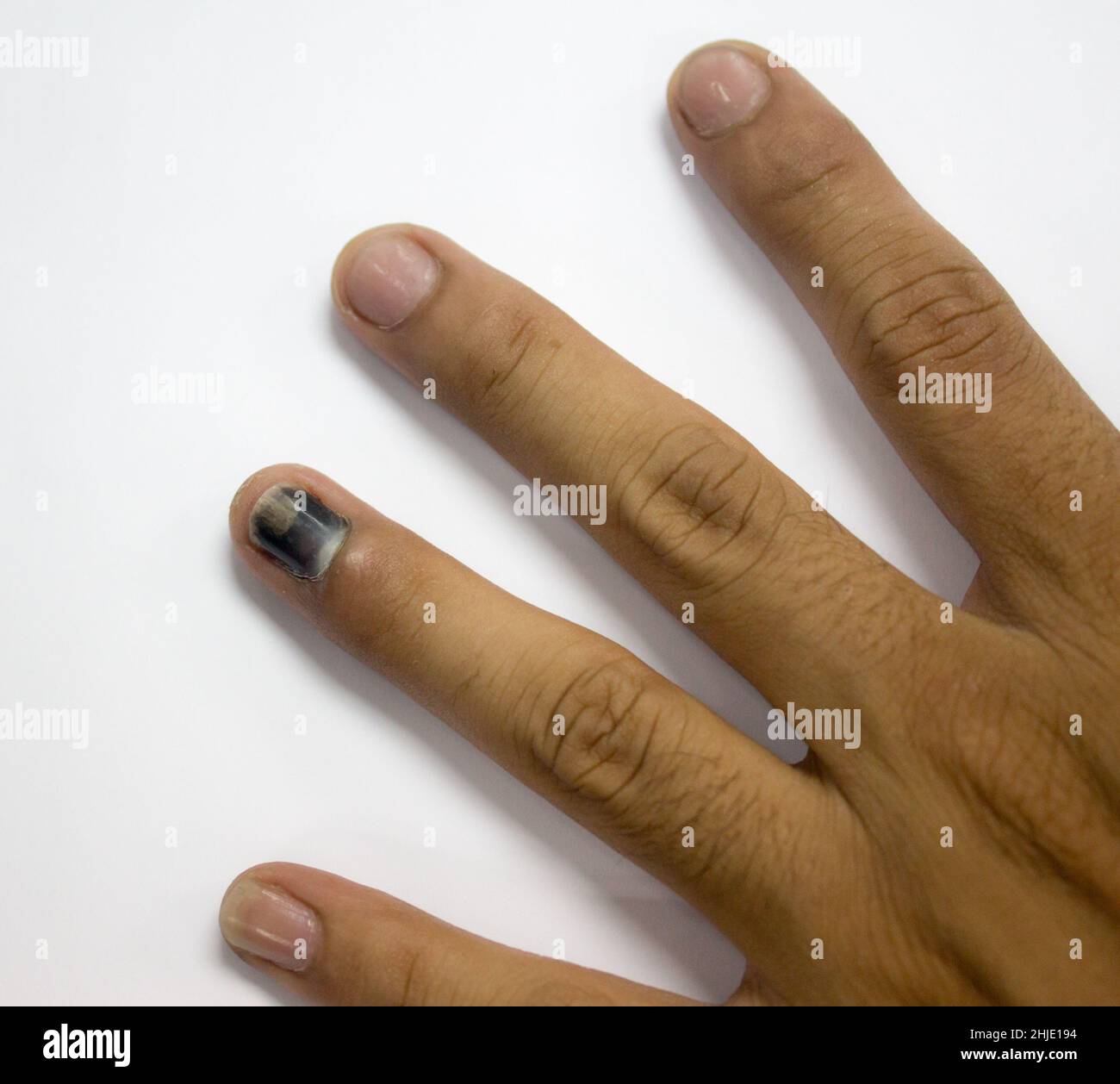 Finger muscle hi-res stock photography and images - Alamy