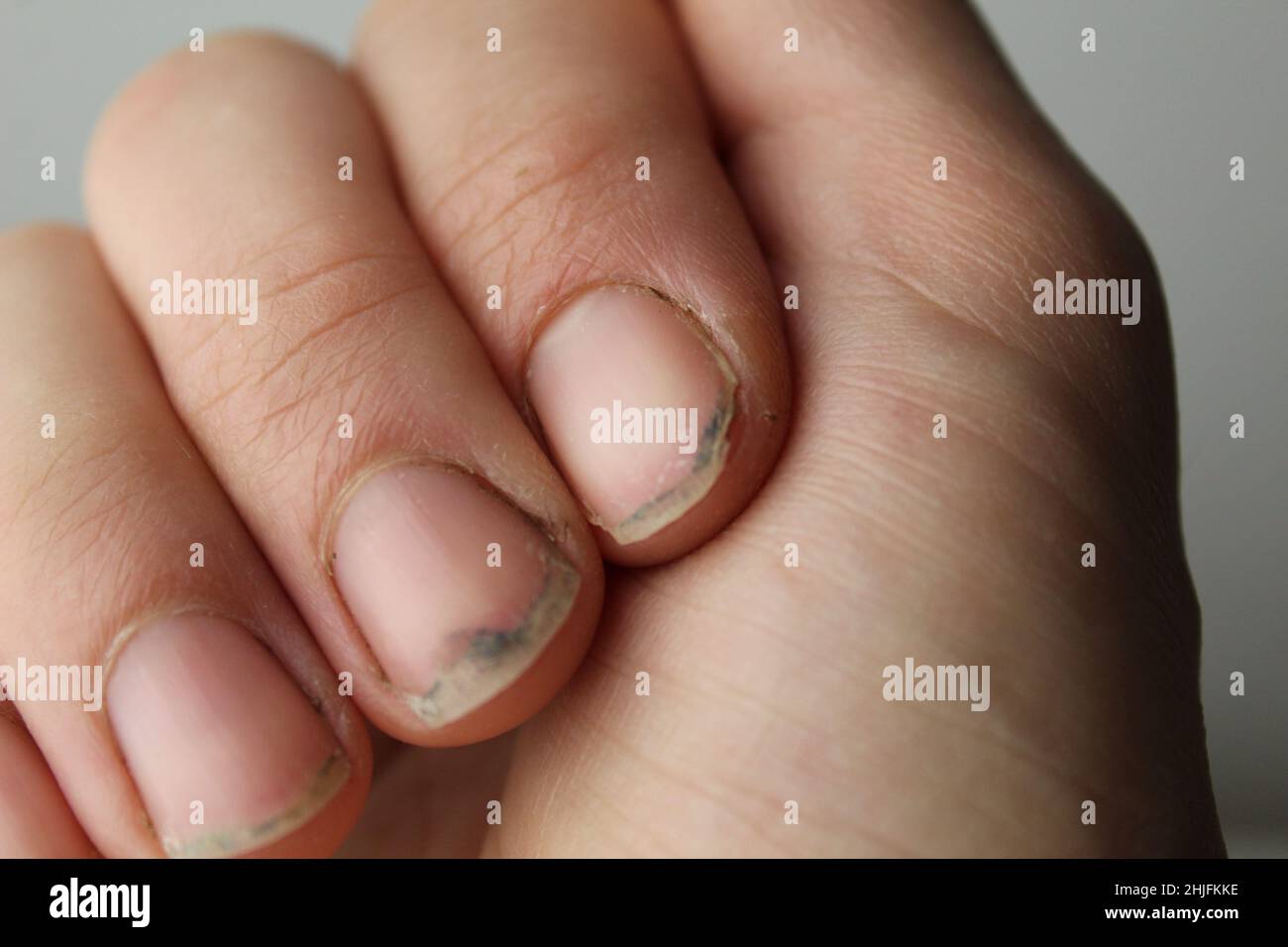 Fingernails brittle hi-res stock photography and images - Alamy