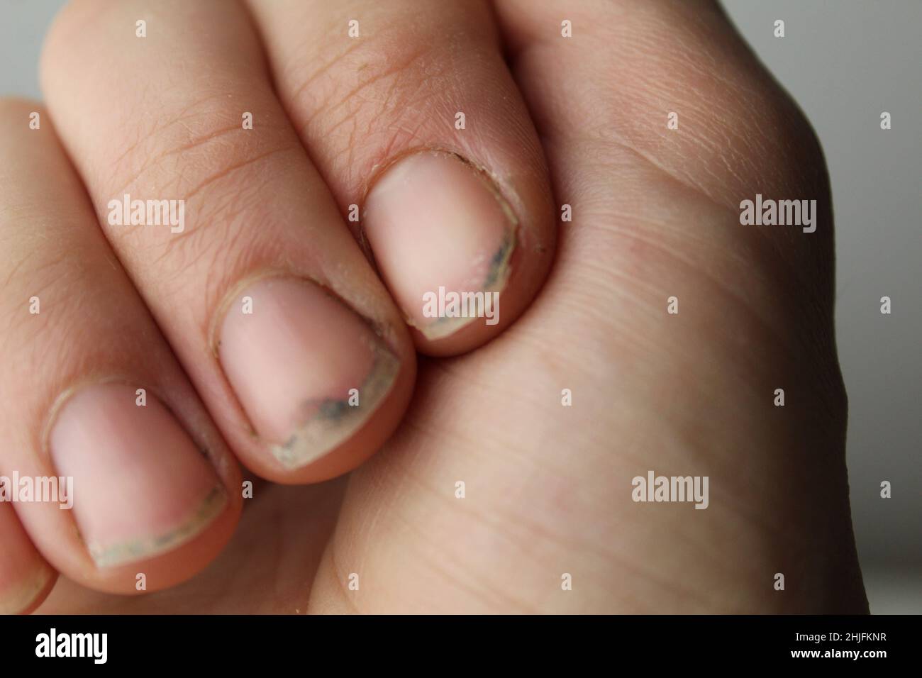 Damaged nail hi-res stock photography and images - Alamy