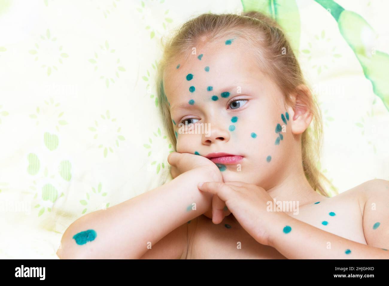 Portrait of a child girl suffering from chicken pox Stock Photo - Alamy