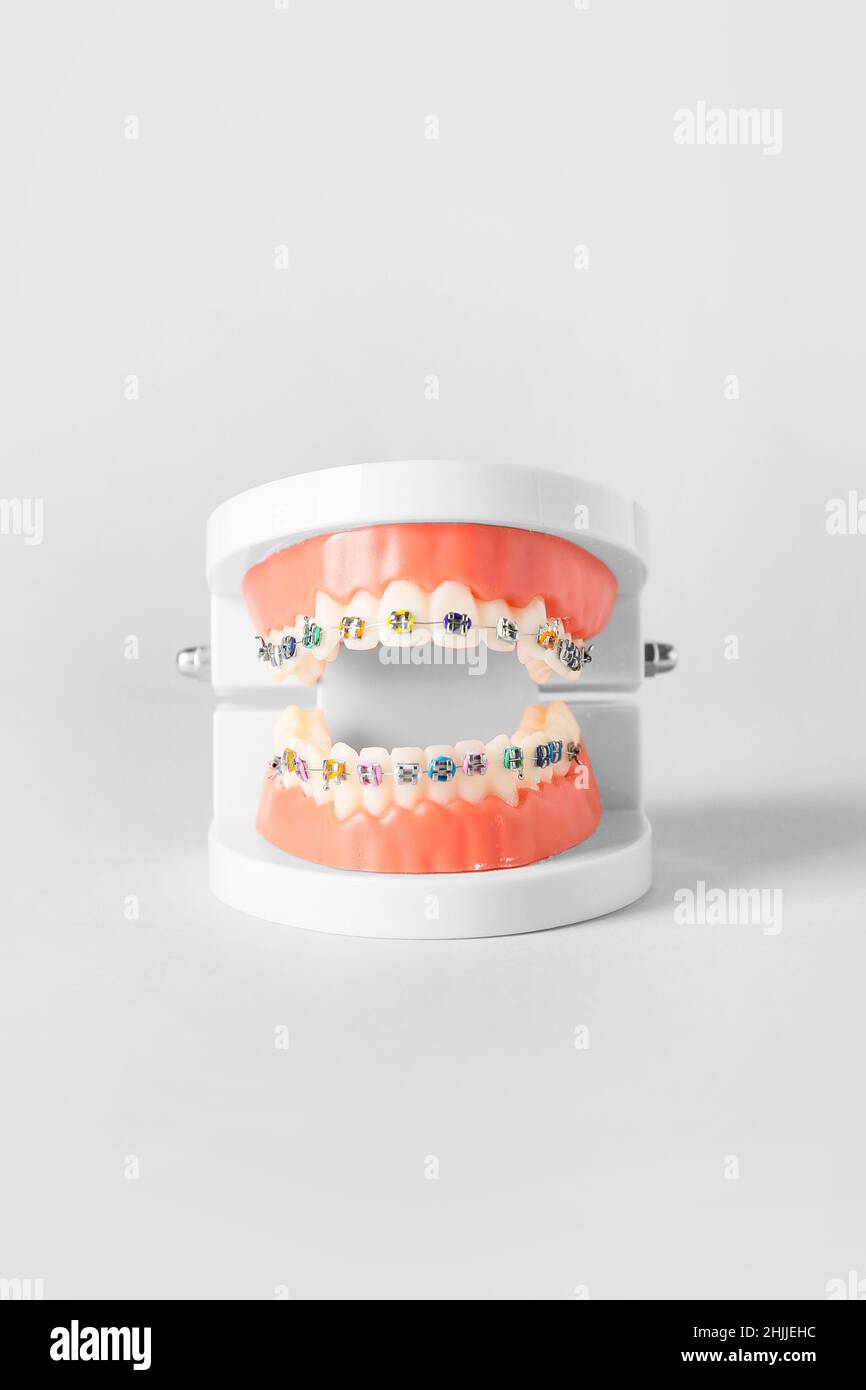 Model of jaw with braces on white background Stock Photo - Alamy