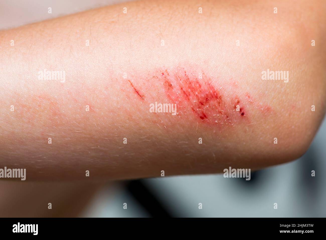 Injury scab hi-res stock photography and images - Alamy