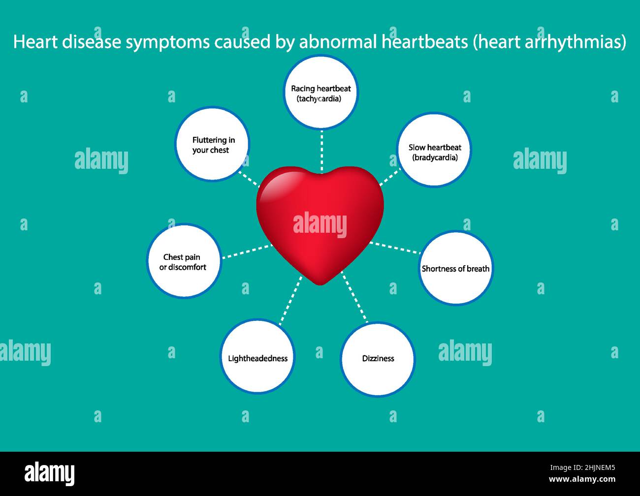 GRAPHICS DRAWING CONCEPT Heart disease symptoms caused by abnormal ...