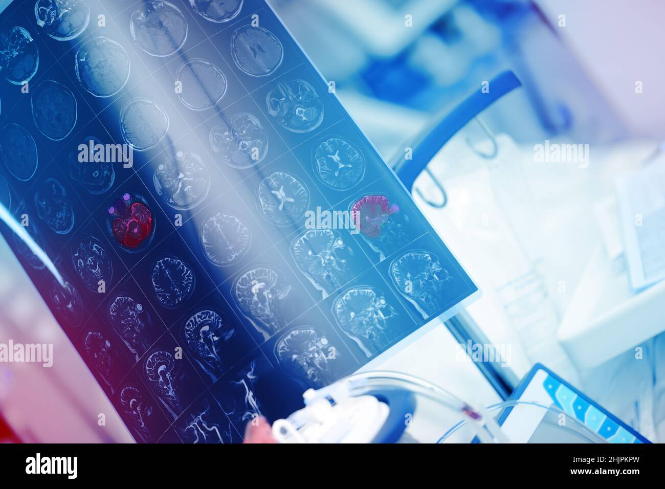 MRI image of human brain with red color marked focal lesion in the ...