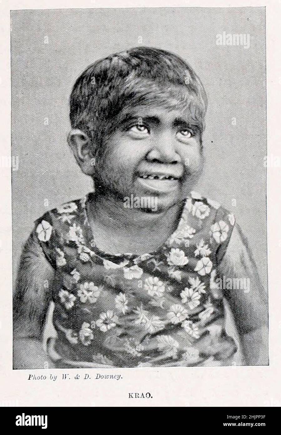 Hypertrichosis Girl Understanding Werewolf Syndrome And Minoxidil