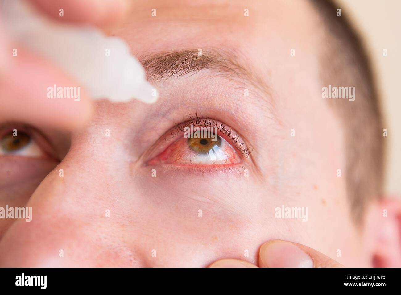 Take care of his eyes. Portrait of a young man with a very red eye ...