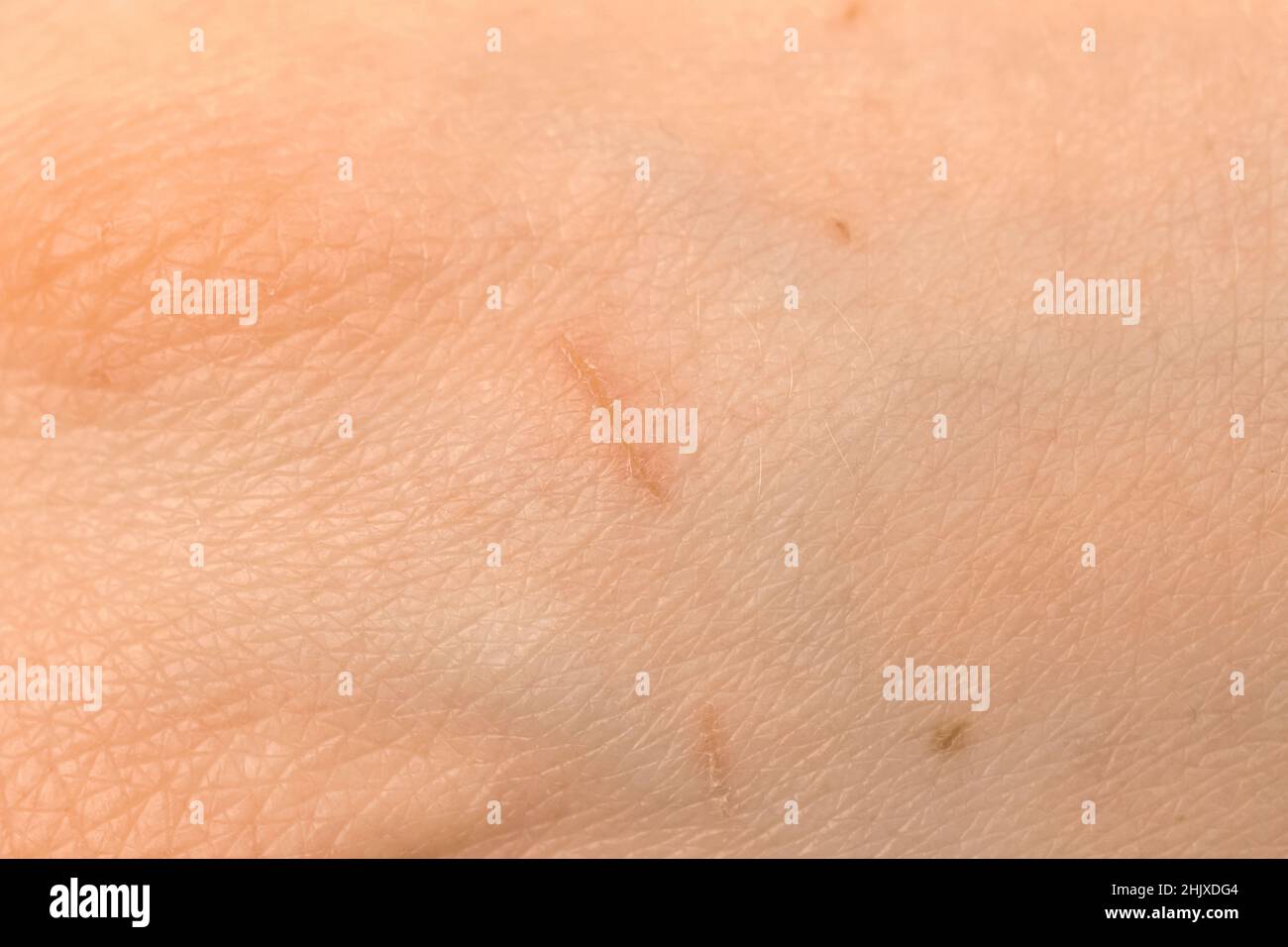 Human skin texture with scratches. Detail healthy pink skin background ...
