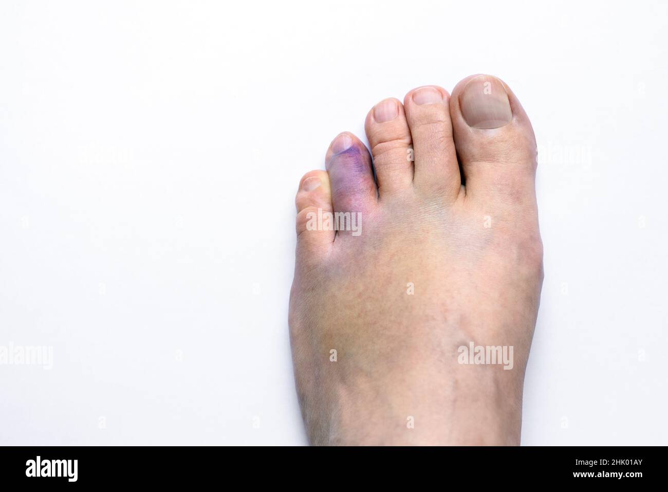 Injured foot with broken toe on white background Stock Photo - Alamy