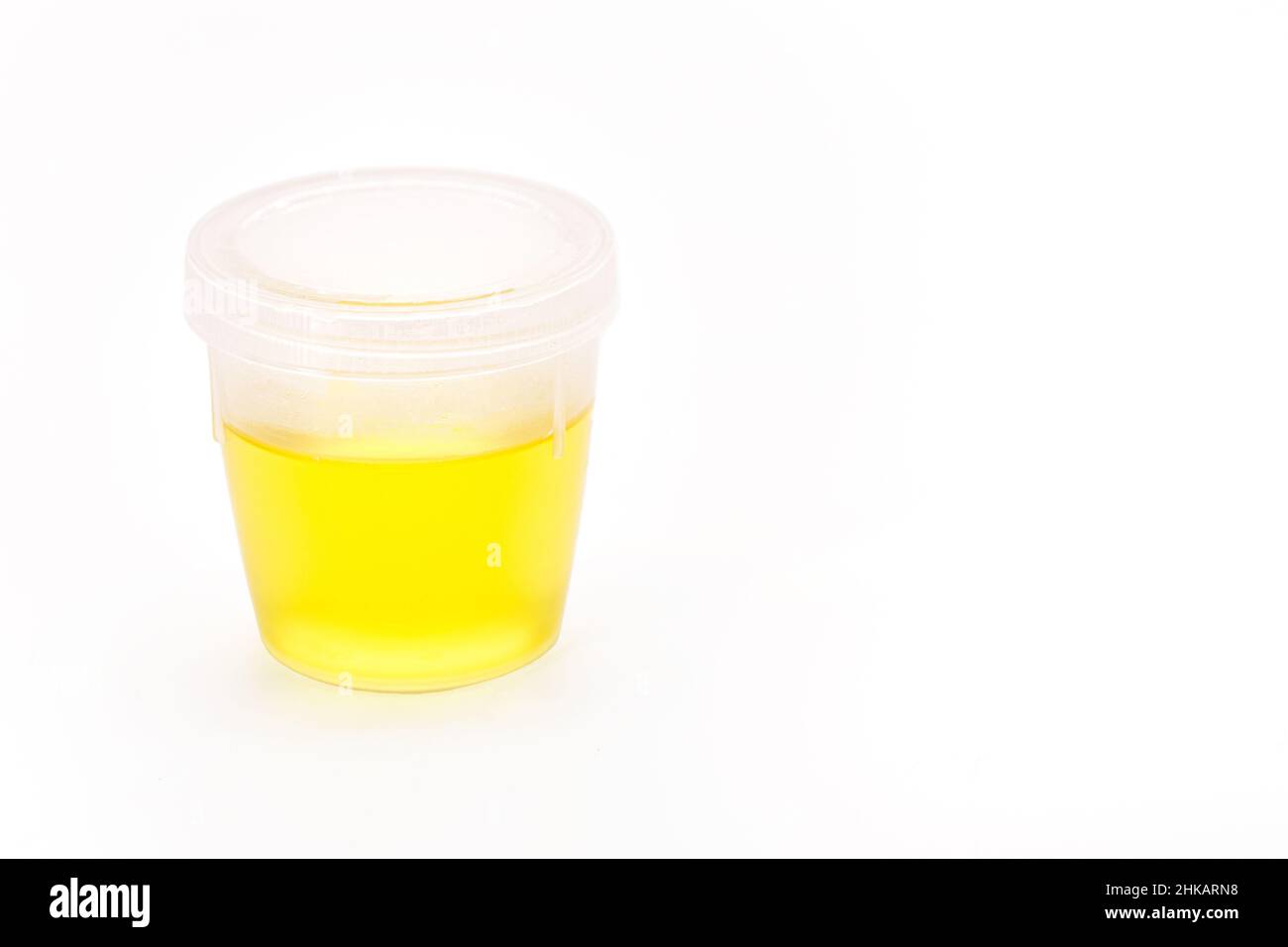 urine for examination collected in disposable plastic bottle ...