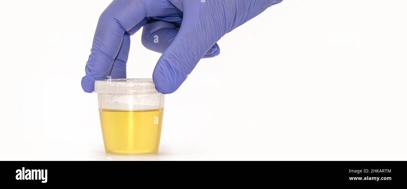 urine collection bottle held by blue gloved hand, EAS urine test. Urine ...