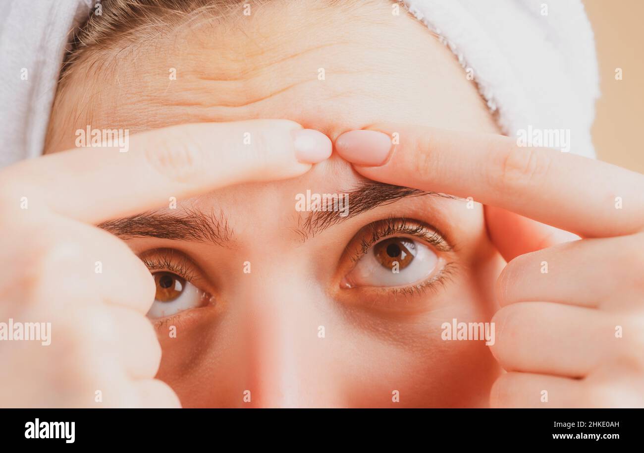 Squeezing pimples, acne, blemish spots skin on on face of young woman ...