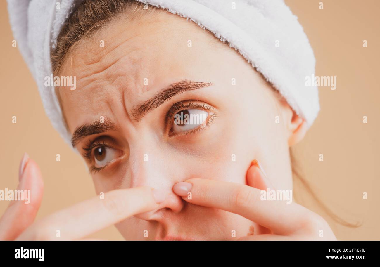 Woman close up face squeezing pimples. Acne blemish spots skin on young ...