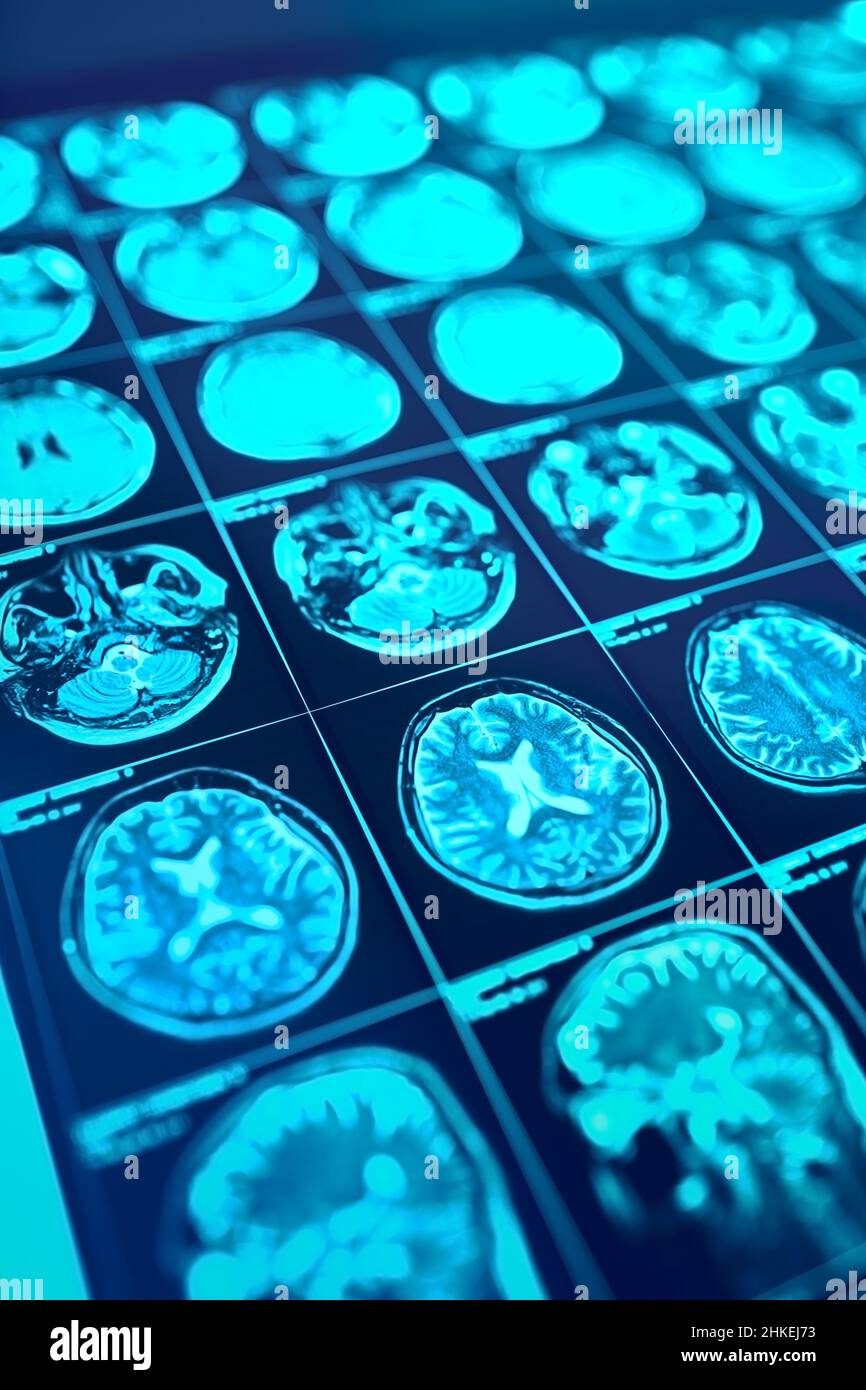 Head scanning series with brain structure on the lightbox Stock Photo ...