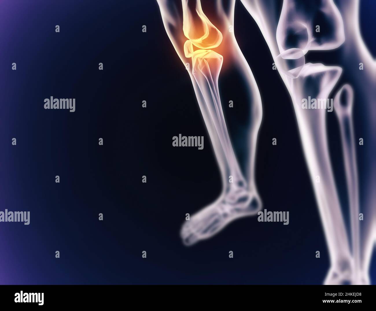 When inflammation strikes. A cgi view of an inflamed joint isolated on ...