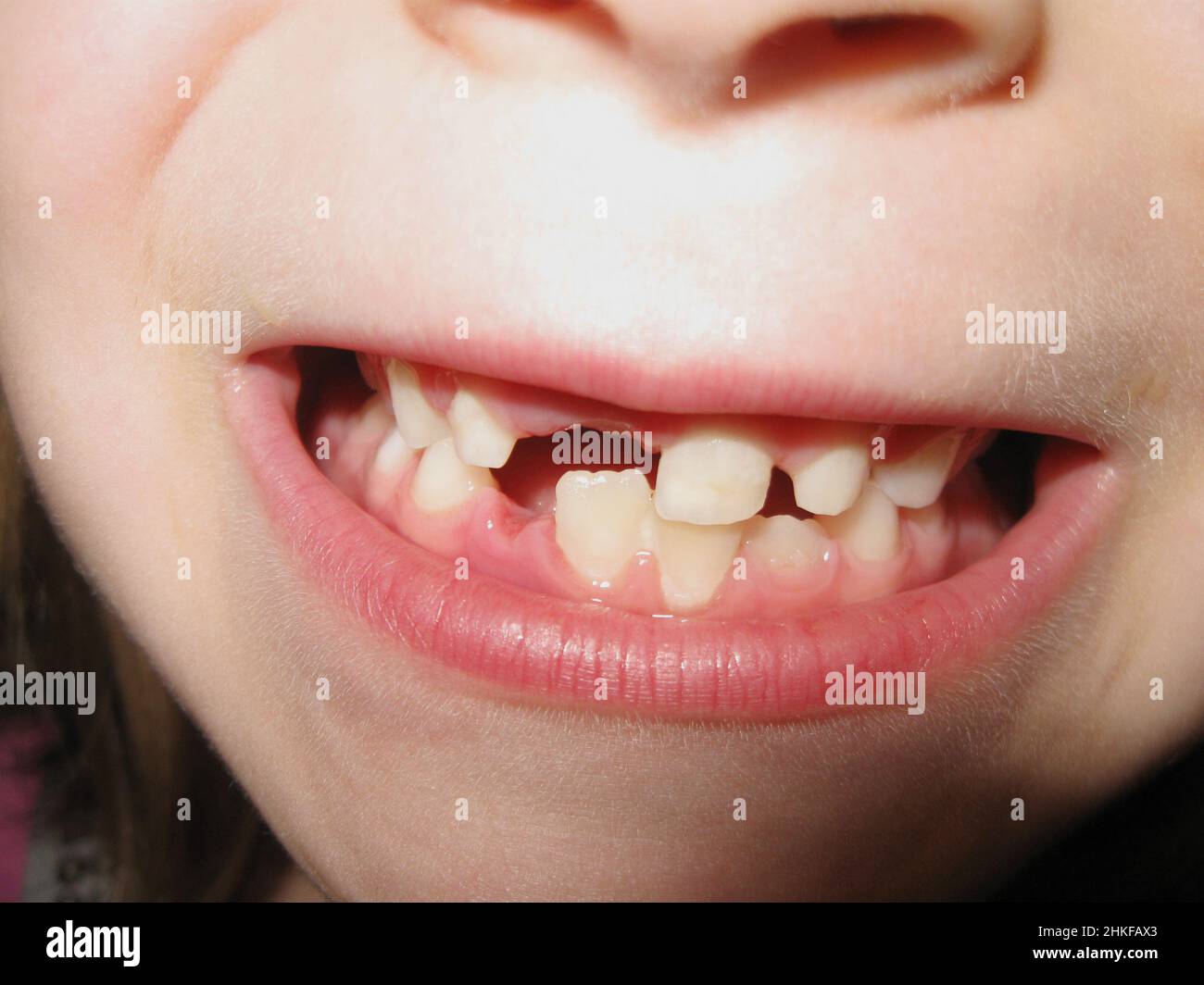 Child girl missing teeth hi-res stock photography and images - Alamy