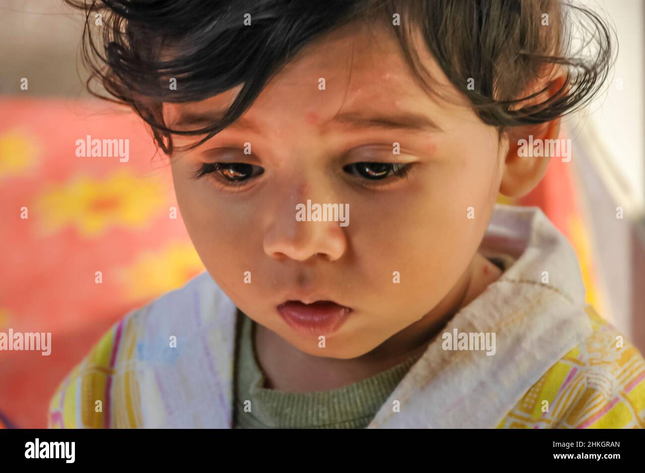 An east Indian baby boy with chicken pox rashes on his face and neck ...