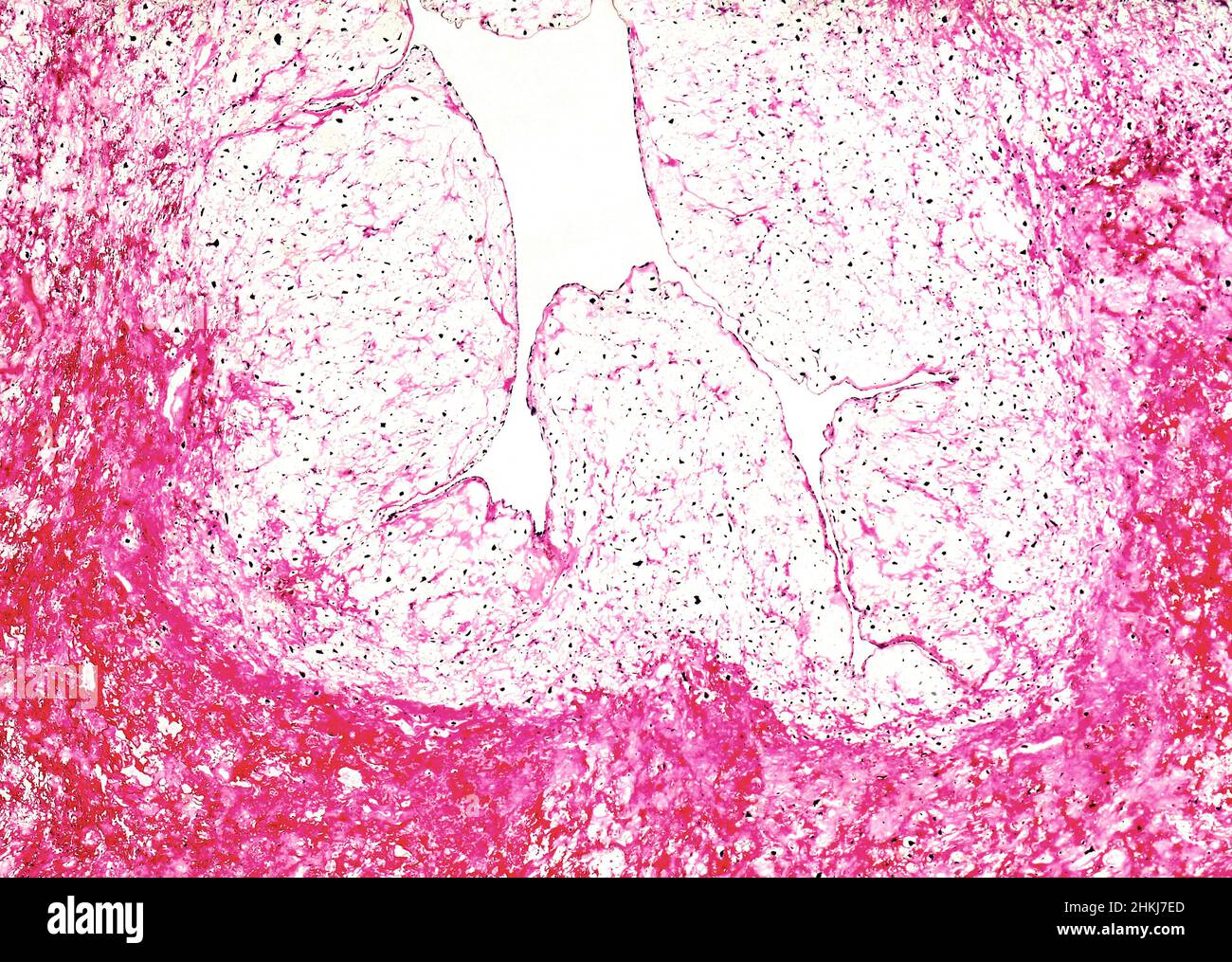 Cardiac sarcoma, light micrograph Stock Photo - Alamy Cardiac sarcoma, light micrograph Stock Photo - Alamy