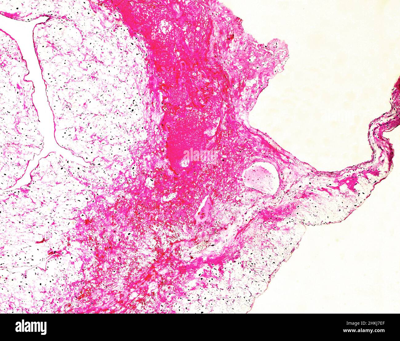 Cardiac sarcoma, light micrograph Stock Photo - Alamy Cardiac sarcoma, light micrograph Stock Photo - Alamy