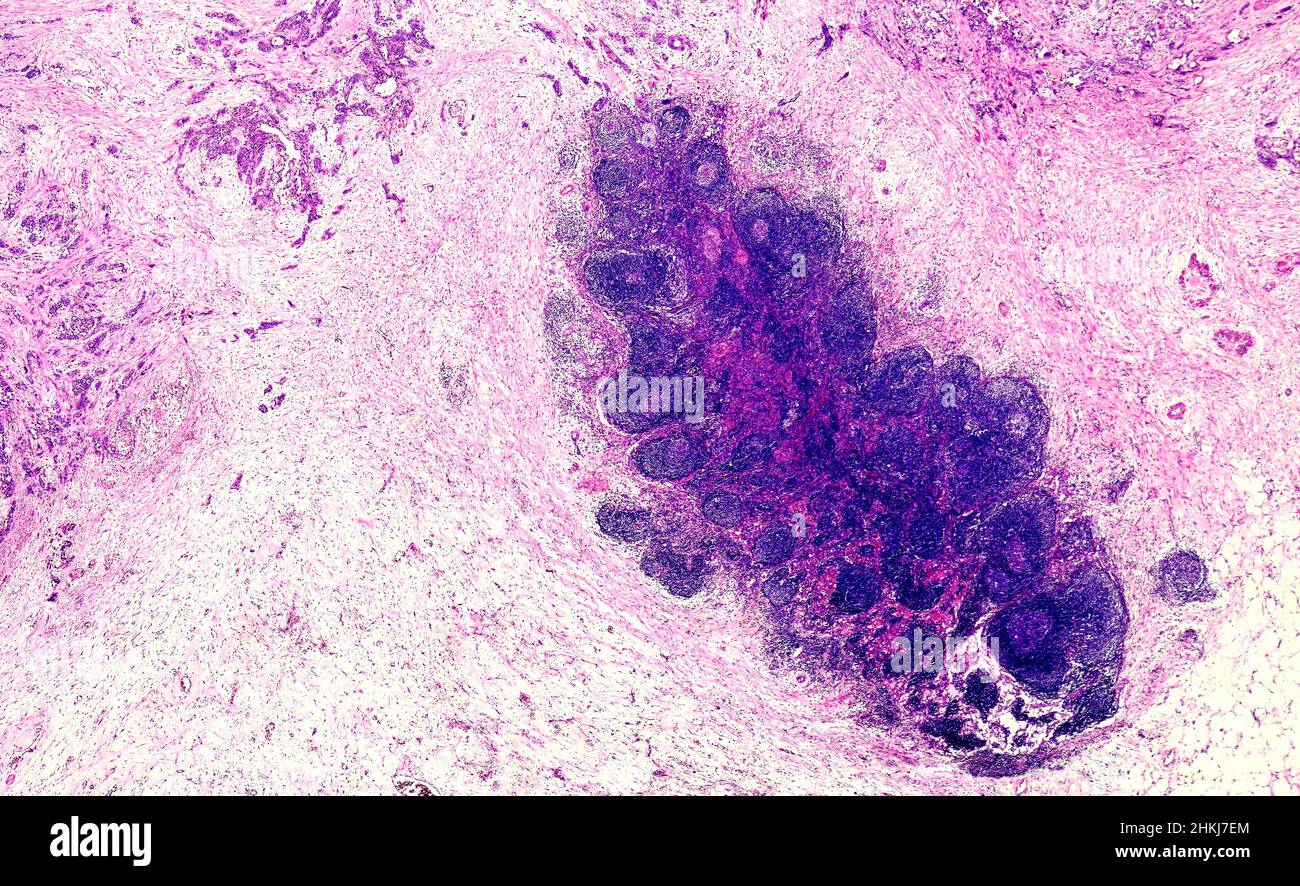 Familial pancreatic cancer, light micrograph Stock Photo - Alamy