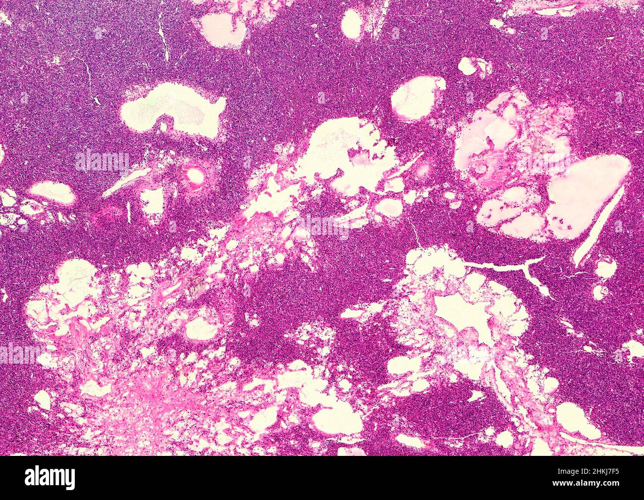 Retiform haemangioendothelioma, light micrograph Stock Photo - Alamy