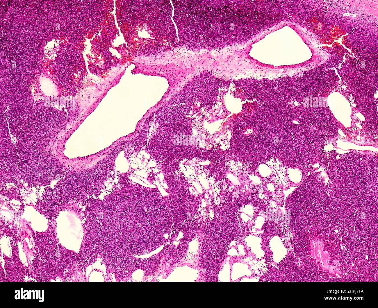 Retiform haemangioendothelioma, light micrograph Stock Photo - Alamy