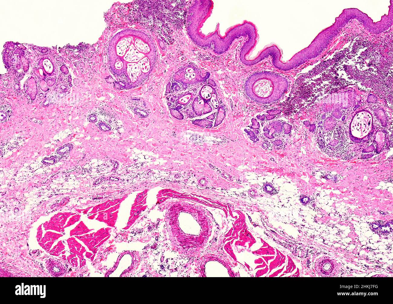 Scabies infected skin, light micrograph Stock Photo - Alamy