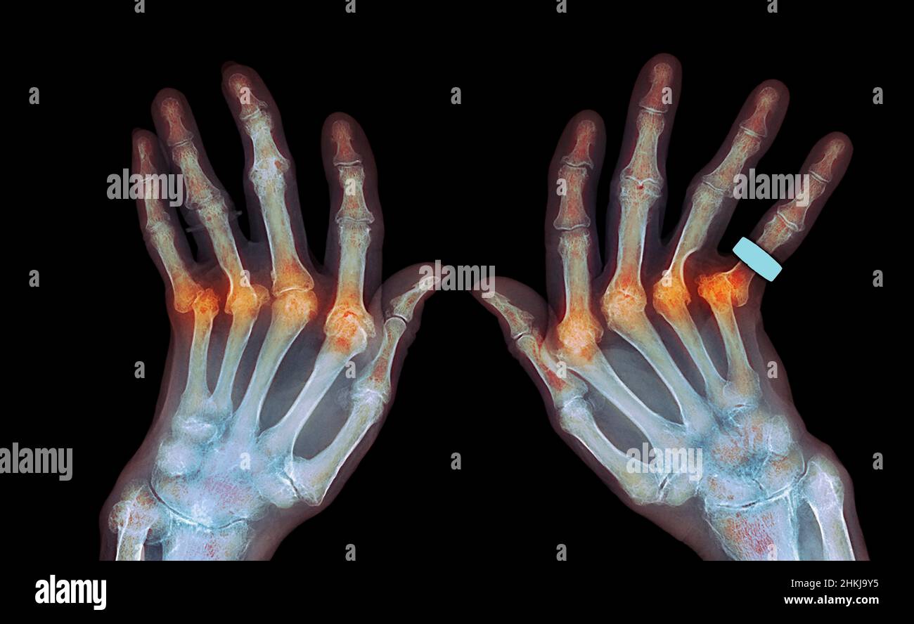 Rheumatoid arthritis, coloured X-ray Stock Photo - Alamy