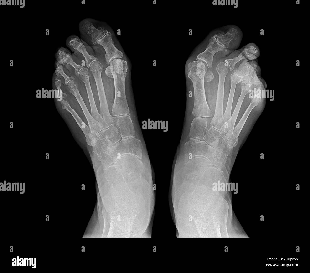 Rheumatoid arthritis, X-ray Stock Photo - Alamy