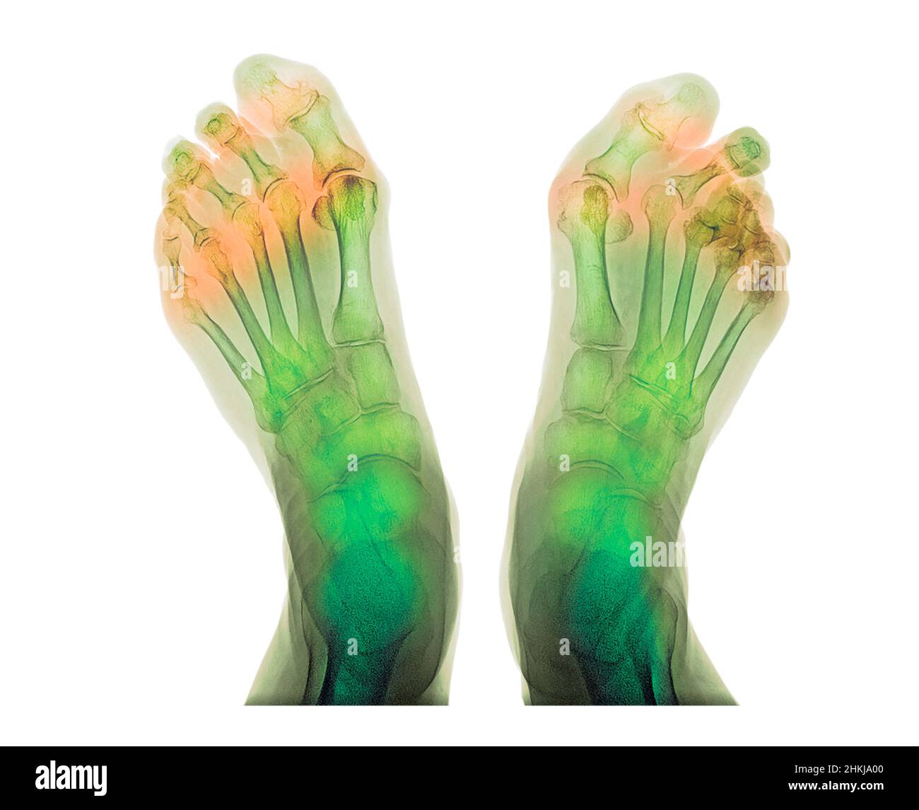 Rheumatoid arthritis, coloured X-ray Stock Photo - Alamy