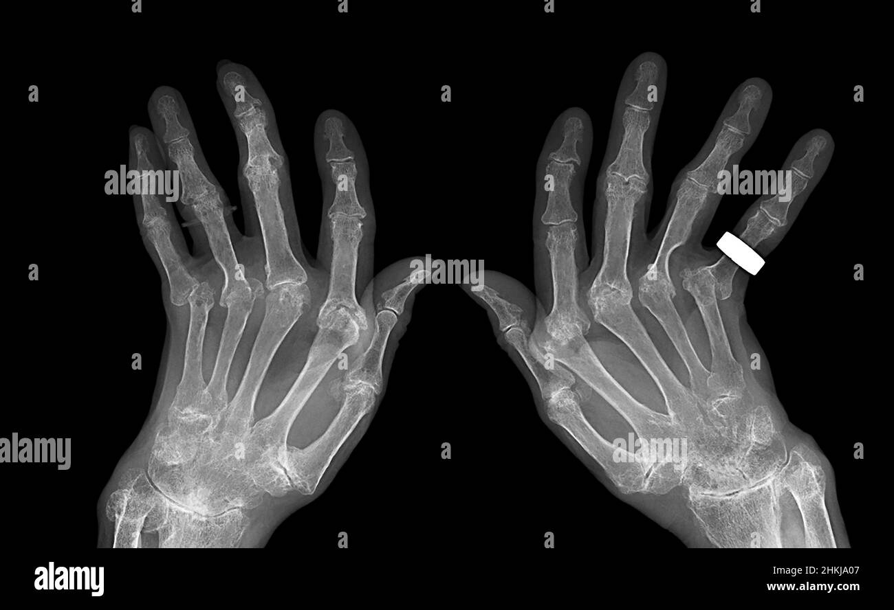 Rheumatoid arthritis, X-ray Stock Photo - Alamy