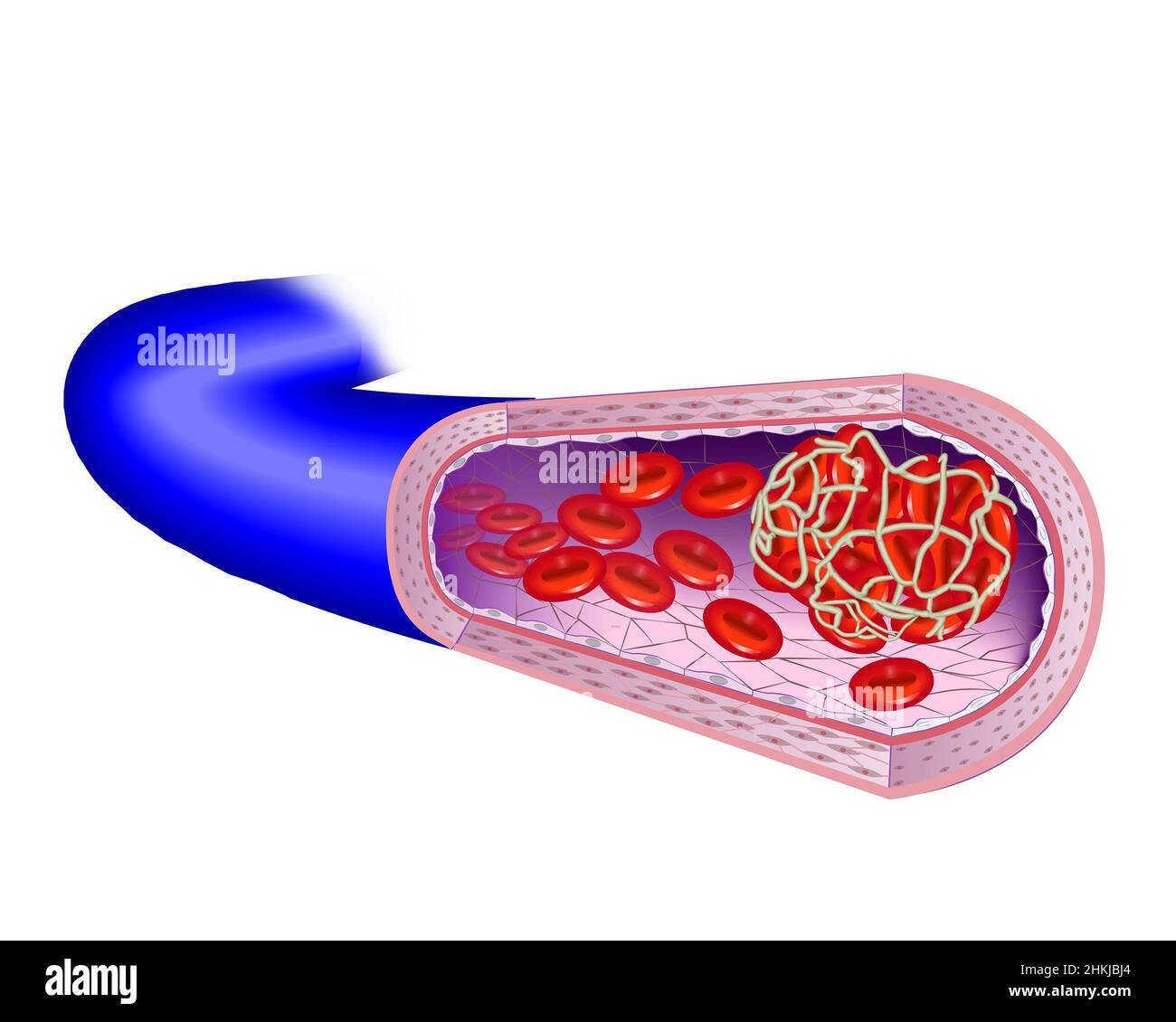 Blood clot formation, illustration Stock Photo - Alamy