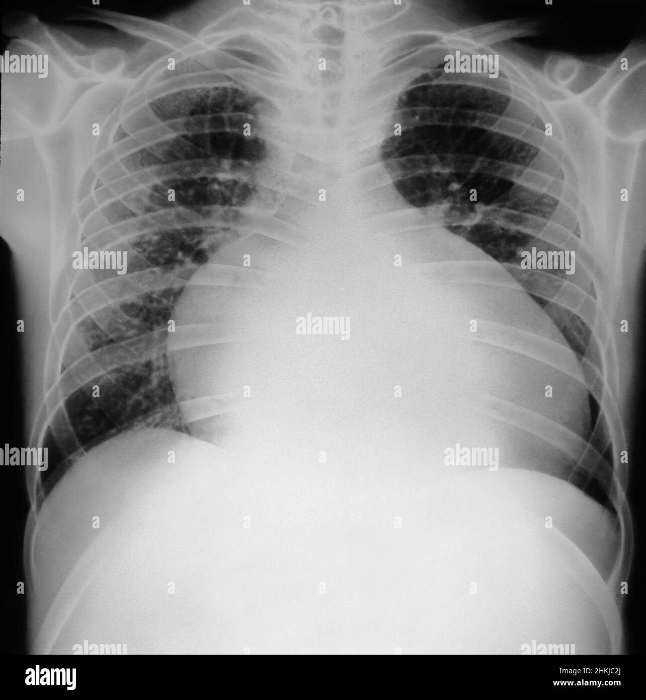 Cardiomyopathy, chest X-ray Stock Photo - Alamy