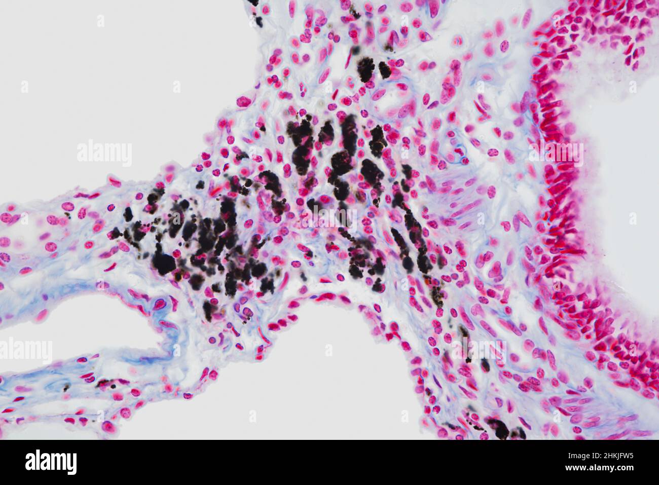 Smoker's lung, light micrograph Stock Photo - Alamy