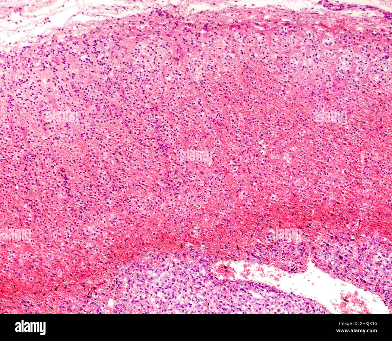 Waterhouse-Friderichsen syndrome, light micrograph Stock Photo - Alamy