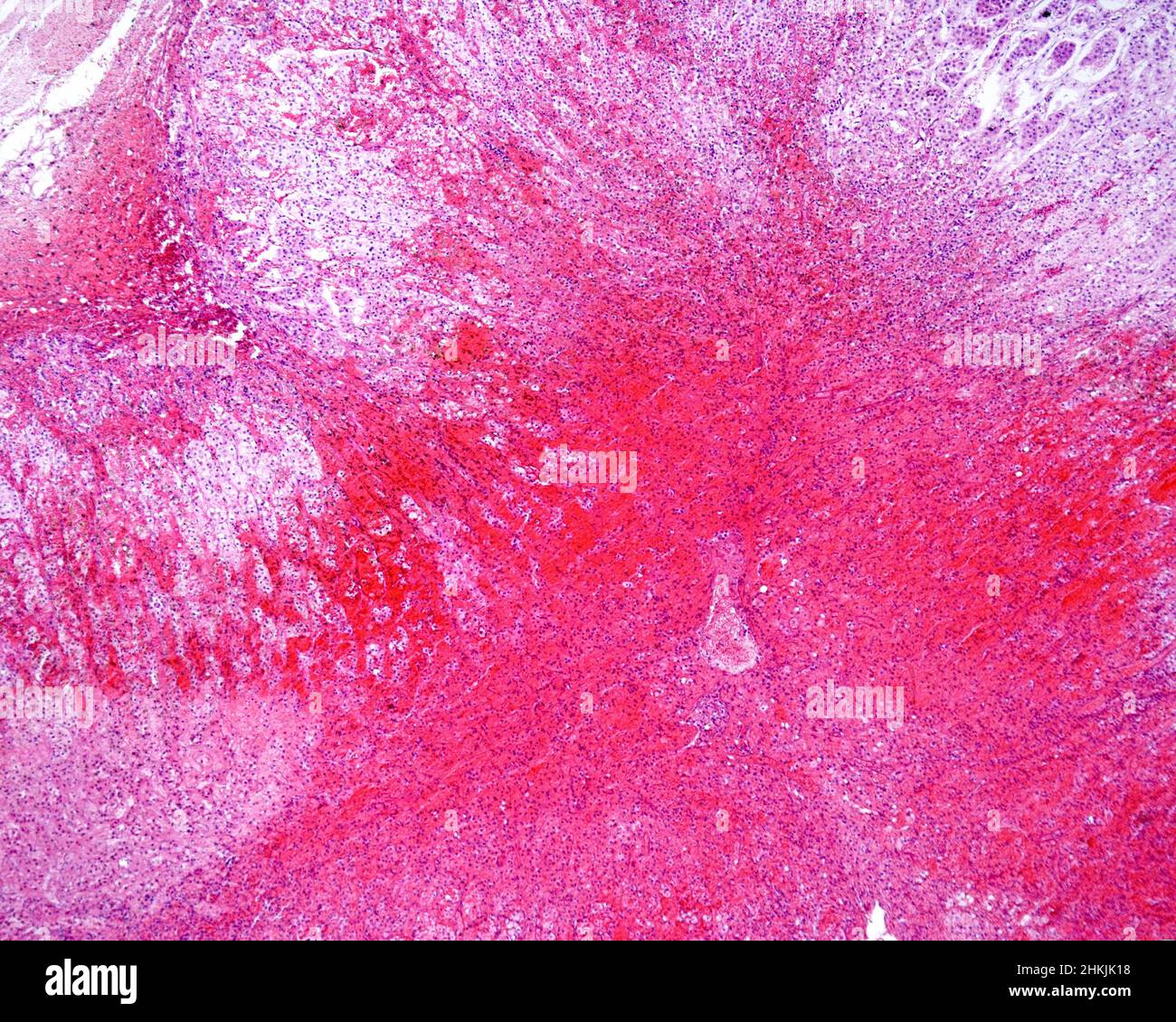 Waterhouse-Friderichsen syndrome, light micrograph Stock Photo - Alamy