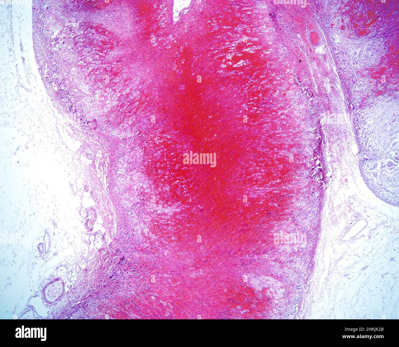 Waterhouse-Friderichsen syndrome, light micrograph Stock Photo - Alamy