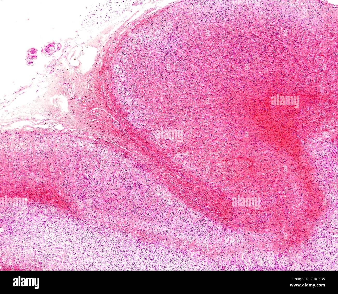 Waterhouse-Friderichsen syndrome, light micrograph Stock Photo - Alamy