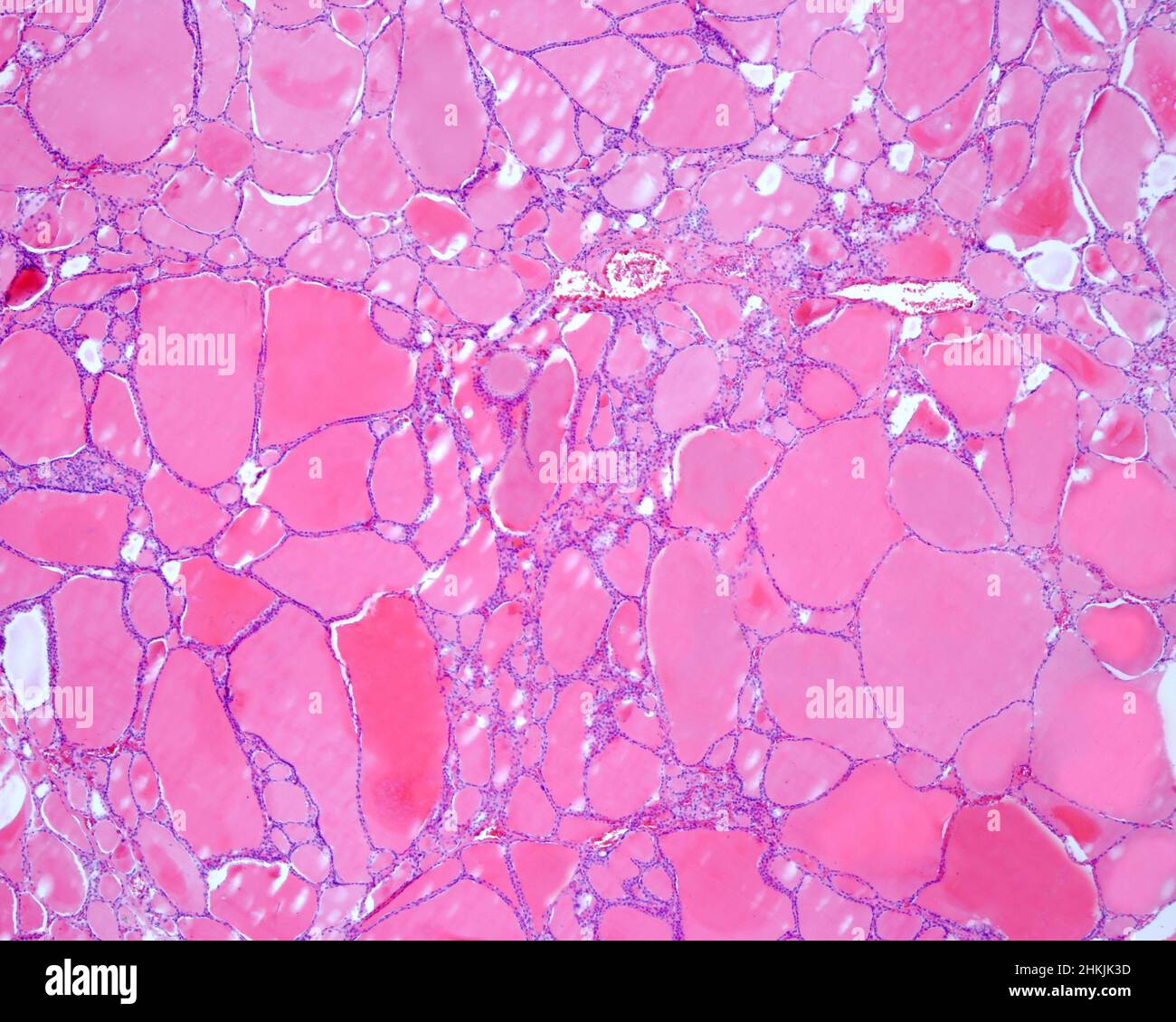 Diffuse goitre, light micrograph Stock Photo - Alamy