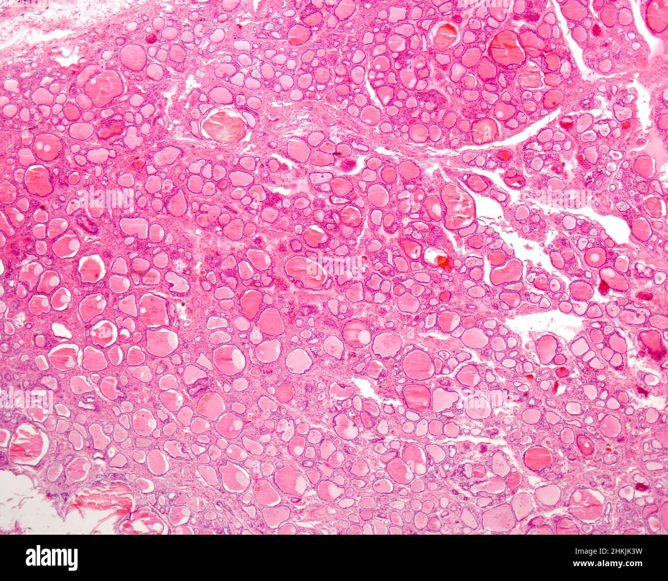 Human thyroid gland, light micrograph Stock Photo - Alamy