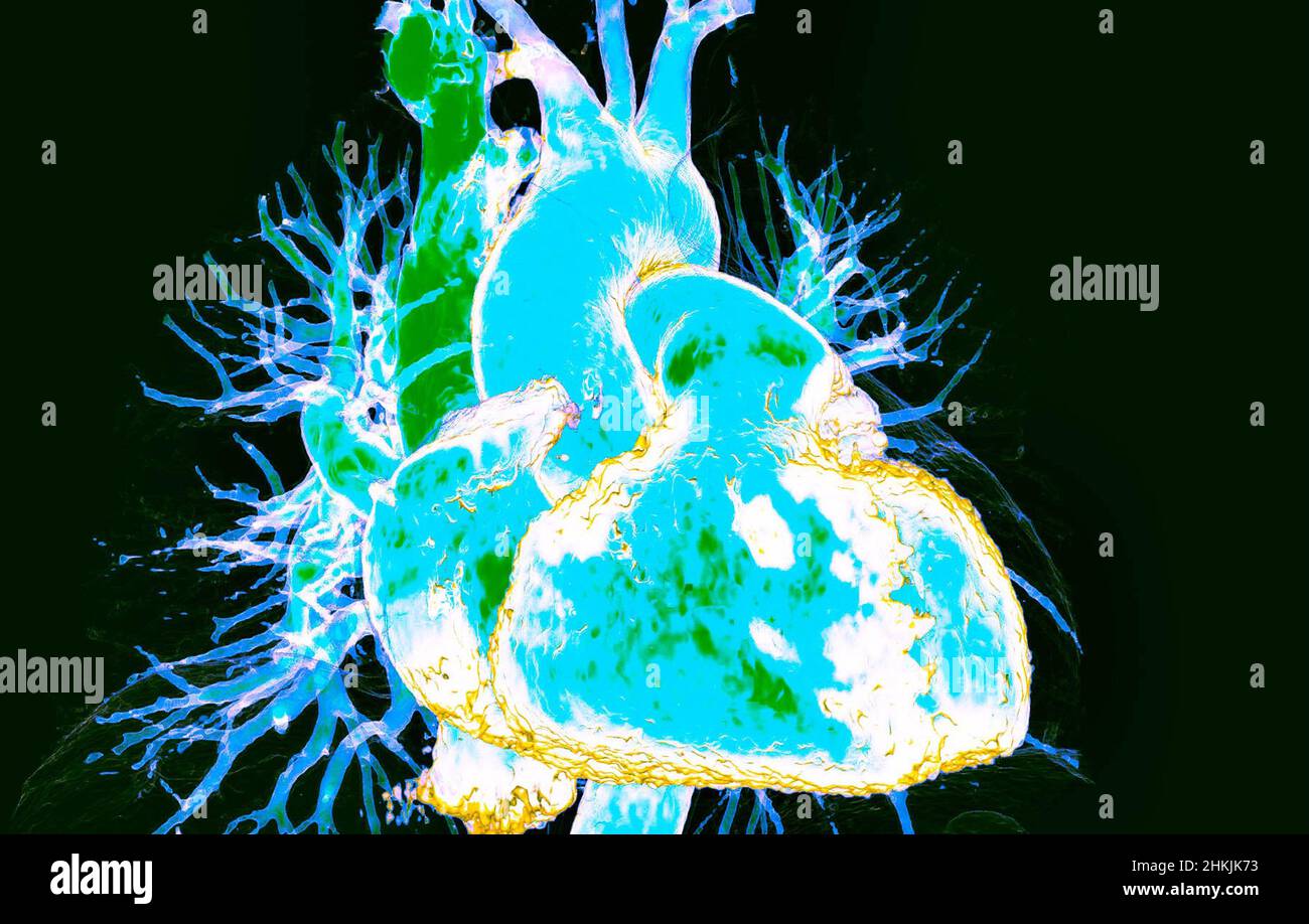 Healthy heart, 3D CT scan Stock Photo - Alamy